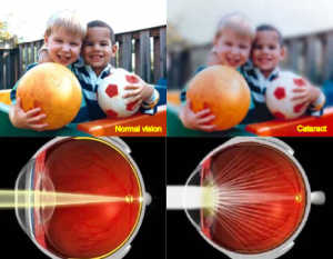 Defects of Vision and their Correction - Physics | CLASS X - MENIIT